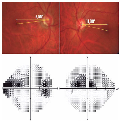 Arquivos Brasileiros de Oftalmologia - Anatomic and refractional ...