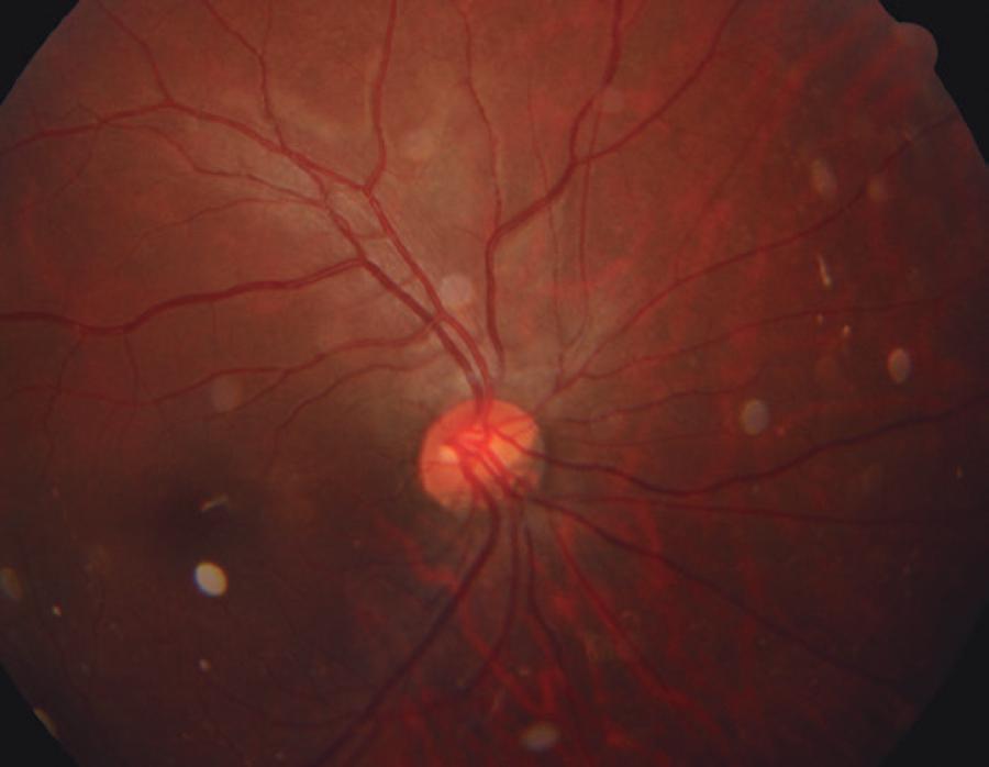 Arquivos Brasileiros de Oftalmologia - Corneal structure in tilted disc ...